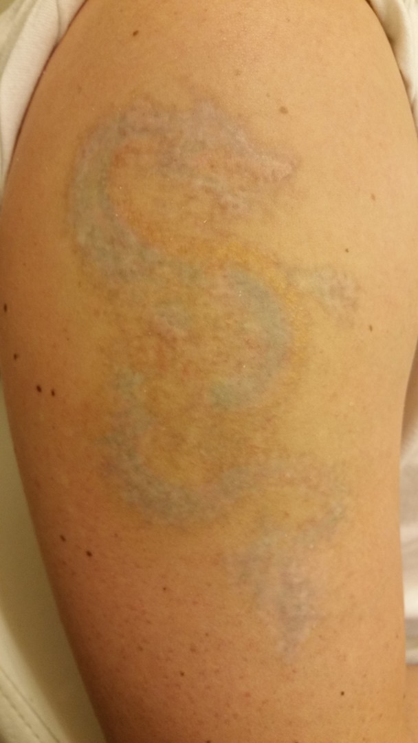 Dermacare Tattoos